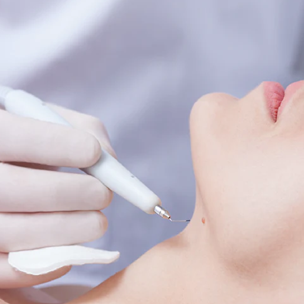 ELIMINACIÓN DE LUNARES Y VERRUGAS – Clínica Globalmedic